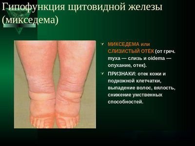 Микседема – хроническое эндокринное заболевание щитовидной железы